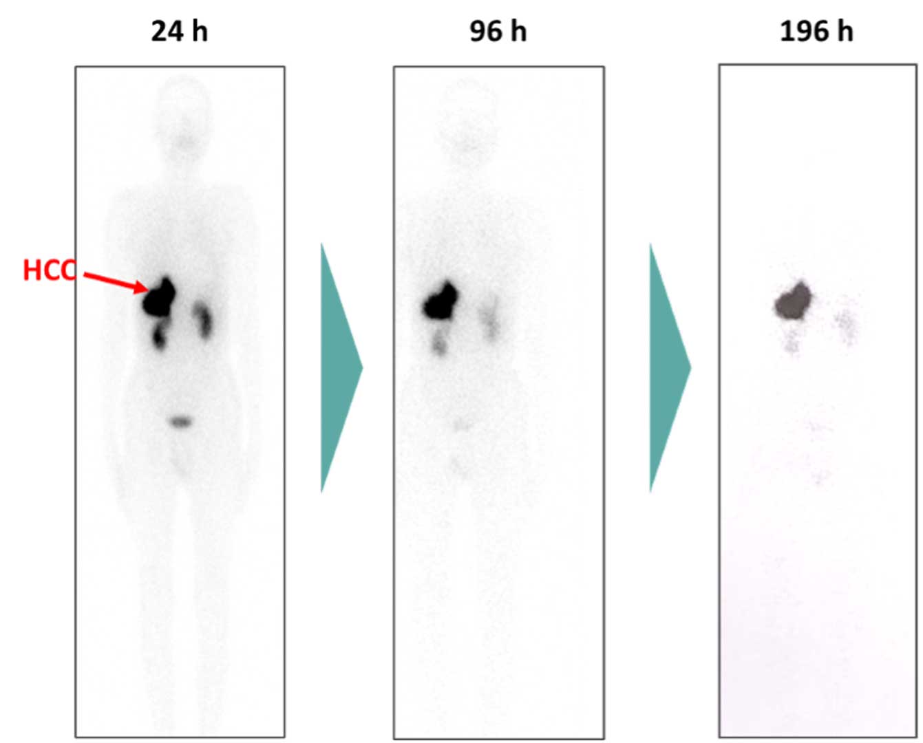 Hepatocellular Carcinoma - RayzeBio